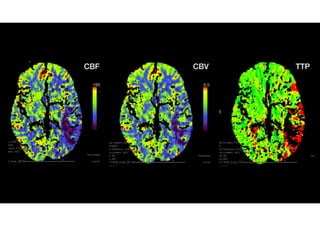Neuro EM: Neuroimaging Nibble CTP mismatch in Acute Ischemic Stroke | PPT
