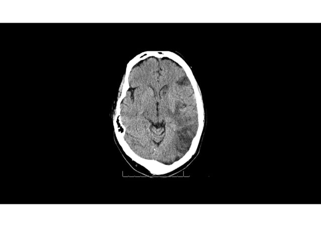 Neuro EM: Neuroimaging Nibble CTP mismatch in Acute Ischemic Stroke | PPT
