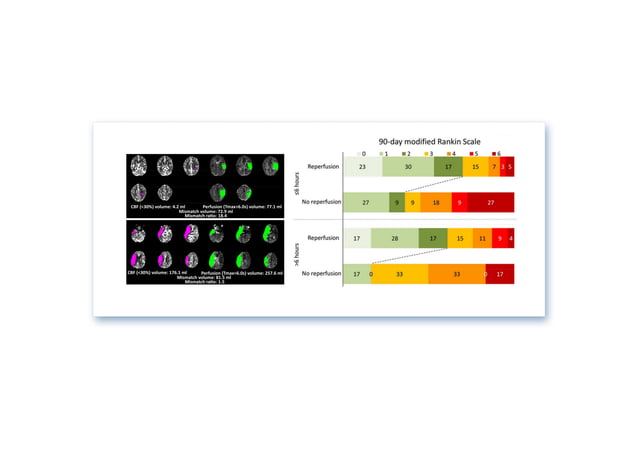 Neuro EM: Neuroimaging Nibble CTP mismatch in Acute Ischemic Stroke | PPT