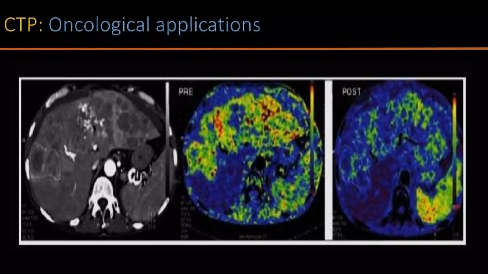 Ct perfusion | PPSX