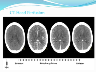 CT_Perfusion.pptx
