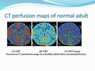 CT_Perfusion.pptx