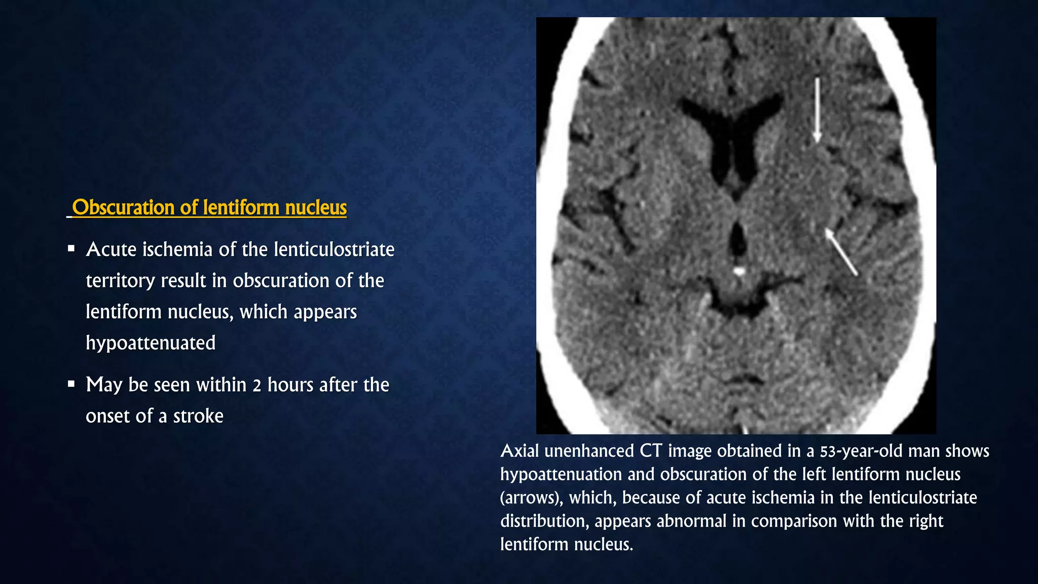 CT perfusion physics and its application in Neuroimaging | PPTX