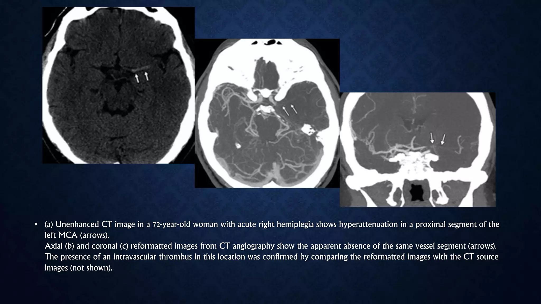 CT perfusion physics and its application in Neuroimaging | PPTX