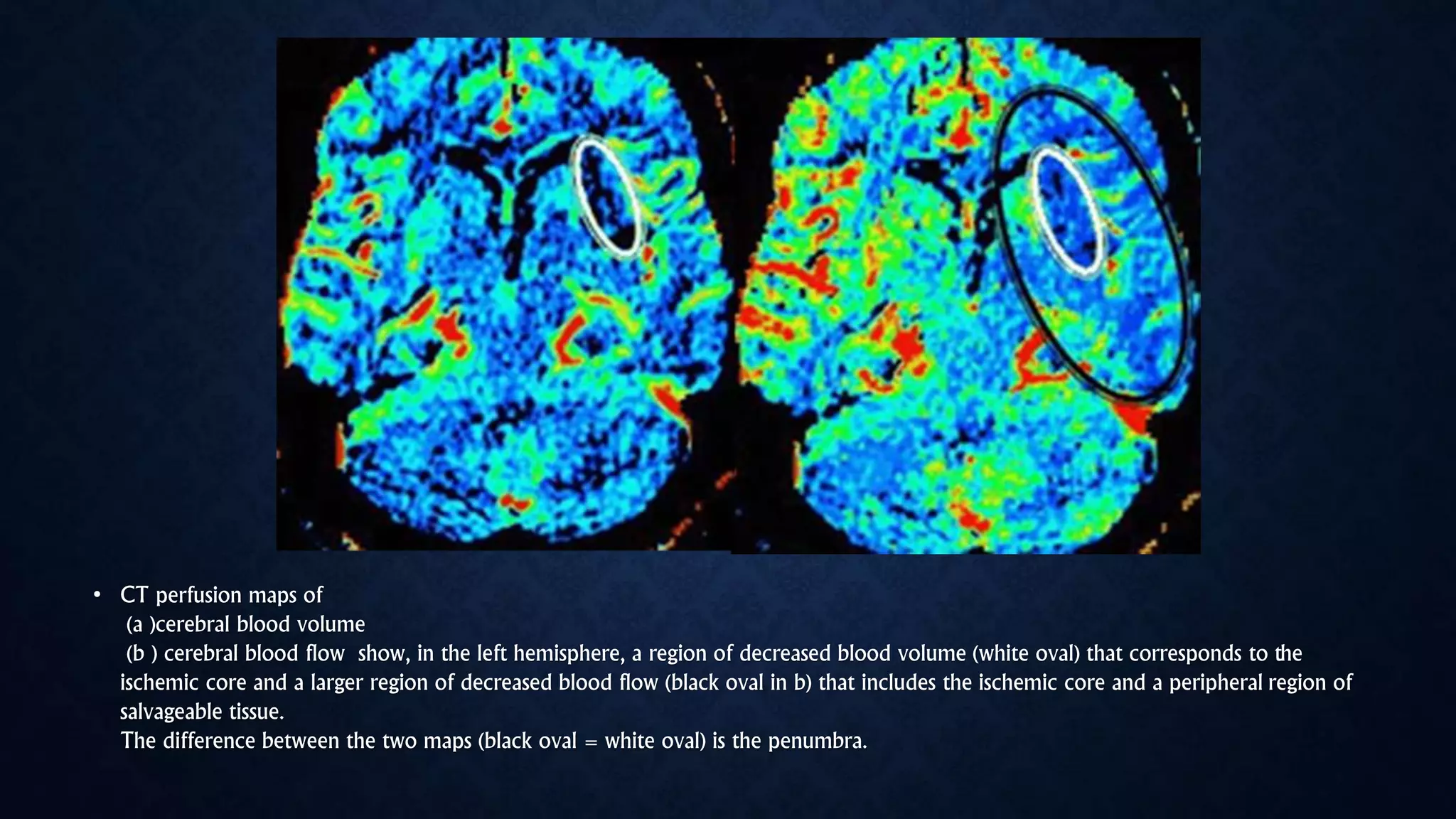 CT perfusion physics and its application in Neuroimaging | PPTX