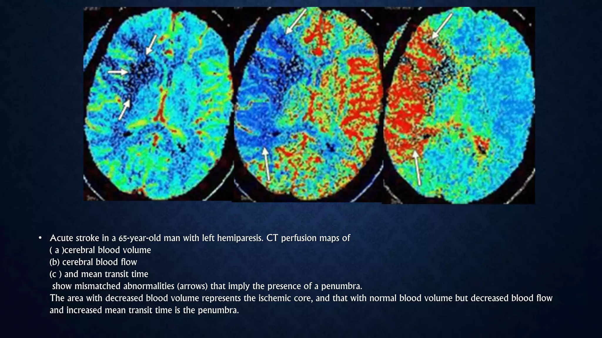 CT perfusion physics and its application in Neuroimaging | PPTX