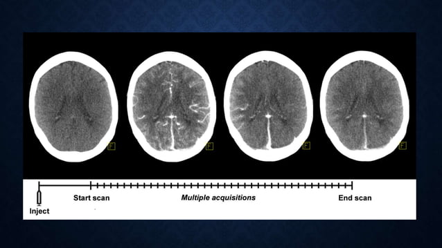 CT perfusion physics and its application in Neuroimaging | PPTX ...