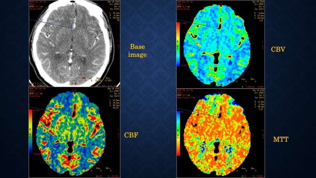CT perfusion physics and its application in Neuroimaging | PPTX ...