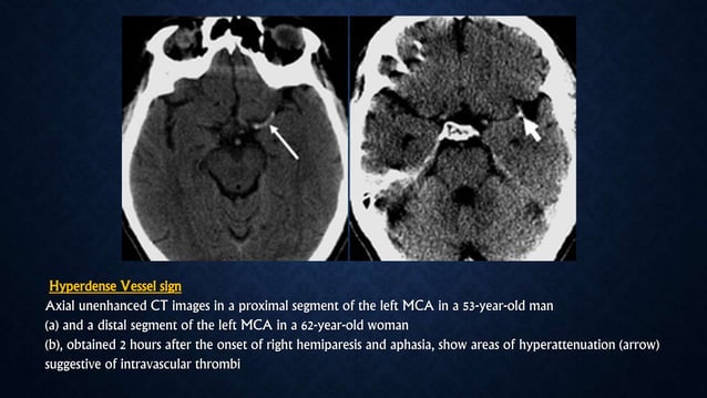 CT perfusion physics and its application in Neuroimaging | PPTX ...
