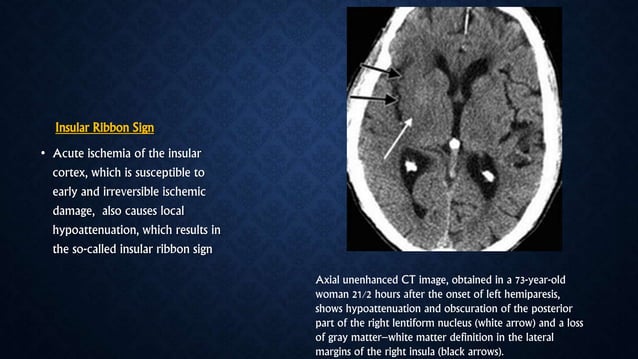 CT perfusion physics and its application in Neuroimaging | PPTX ...