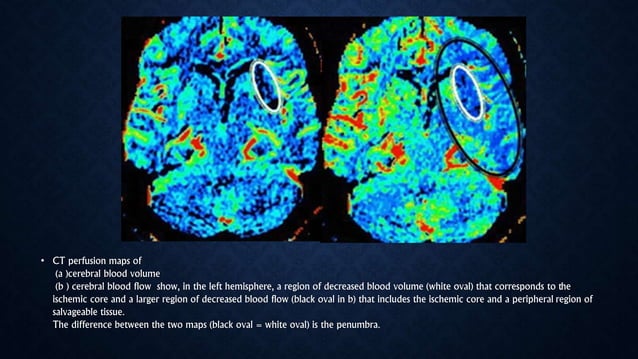 CT perfusion physics and its application in Neuroimaging | PPTX ...