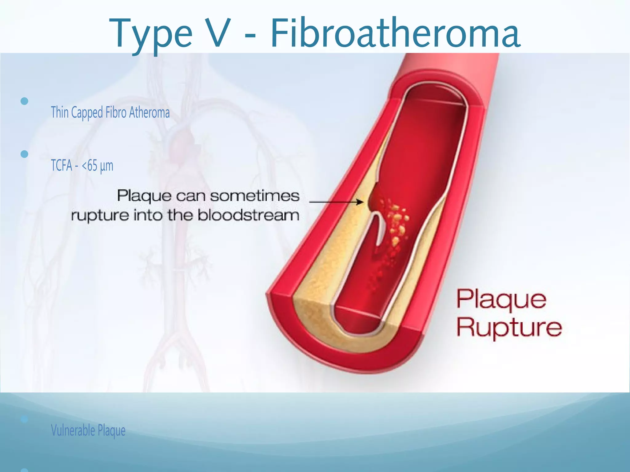 CTCA - CT Coronary Angiography Plaque Characterization | PPT