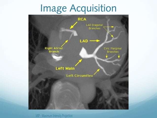 CTCA - CT Coronary Angiography Plaque Characterization | PPT