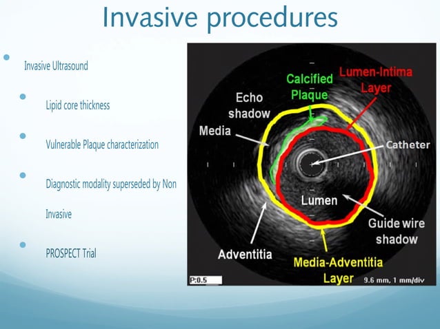 CTCA - CT Coronary Angiography Plaque Characterization | PPT
