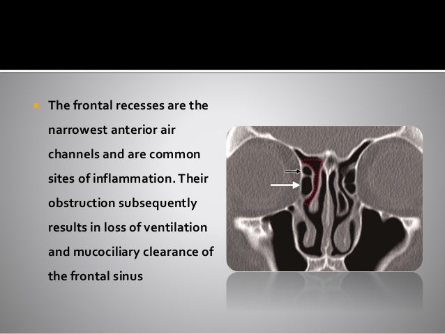 CT ANATOMY OF PARA NASAL SINUSES