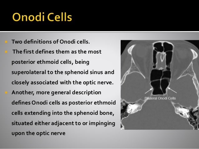 CT ANATOMY OF PARA NASAL SINUSES