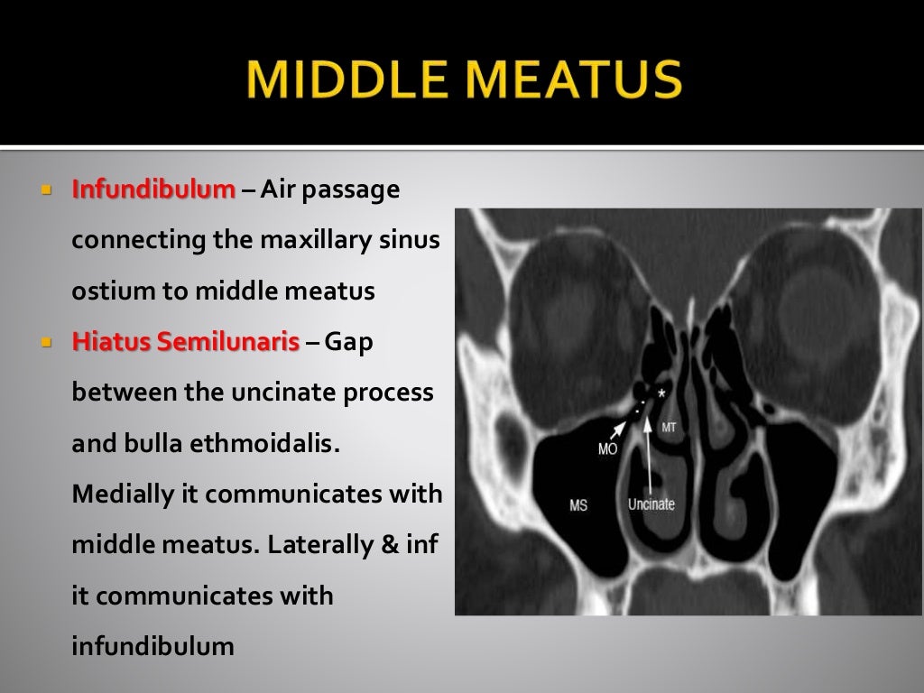 Ct Sinus Anatomy
