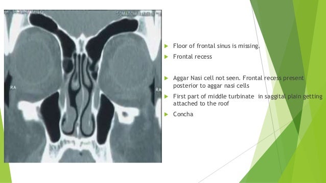 Ct pns - Anatomical varients