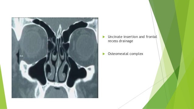 Ct pns - Anatomical varients