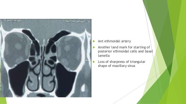 Ct pns - Anatomical varients