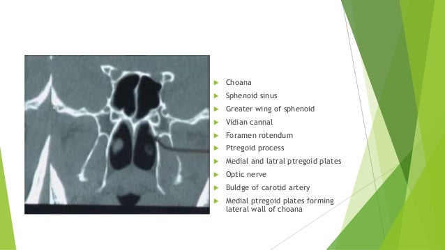 Ct pns - Anatomical varients