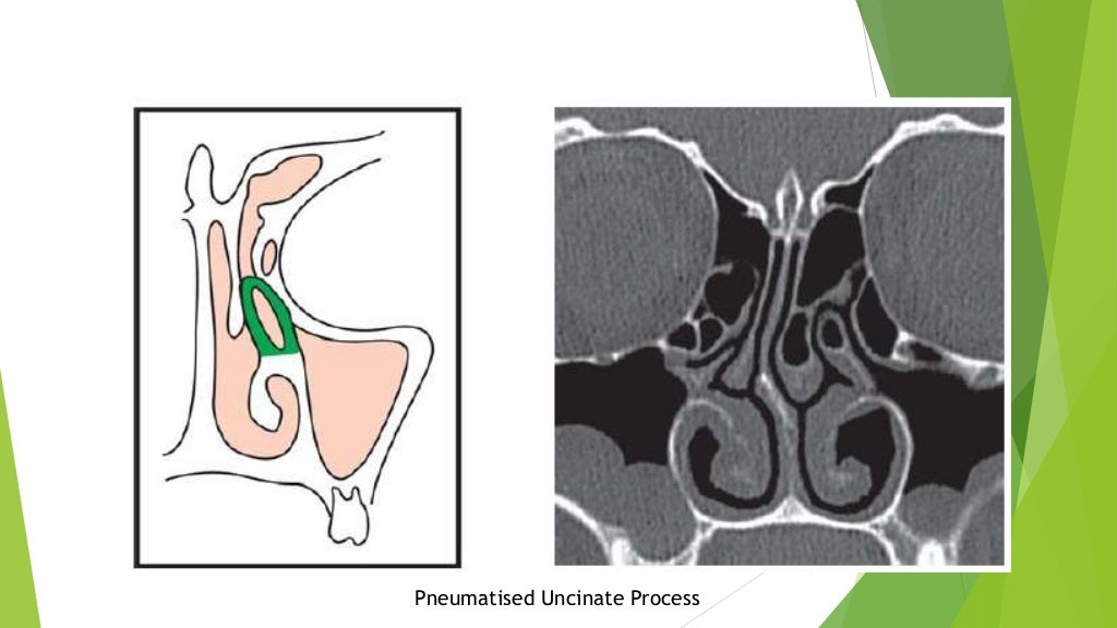 Ct pns - Anatomical varients