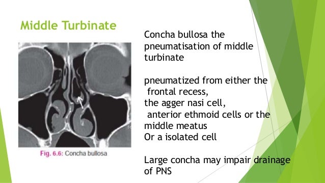 Ct pns - Anatomical varients