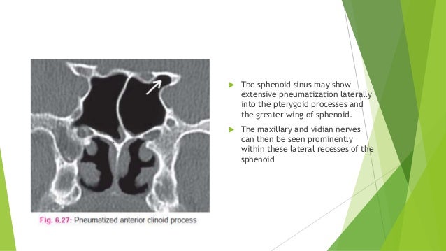 Ct pns - Anatomical varients
