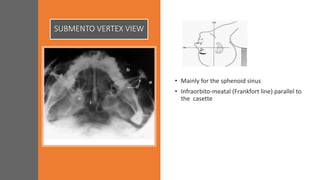 Imaging of paranasal sinuses RV | PPTX