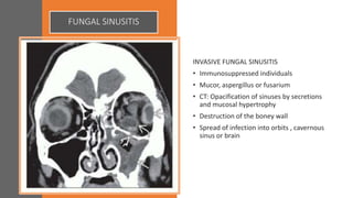 Imaging of paranasal sinuses RV | PPTX