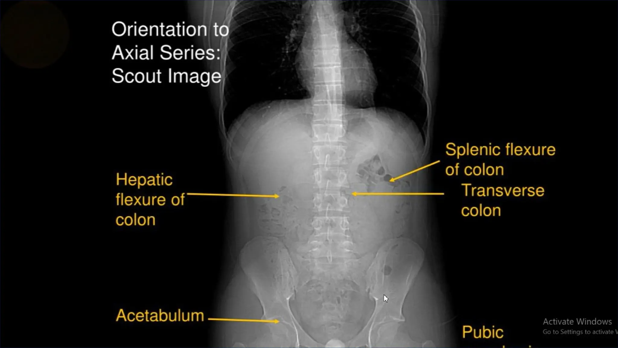 CT PROCEDURE OF ABDOMEN AND PELVIS.pptx imp | PPTX
