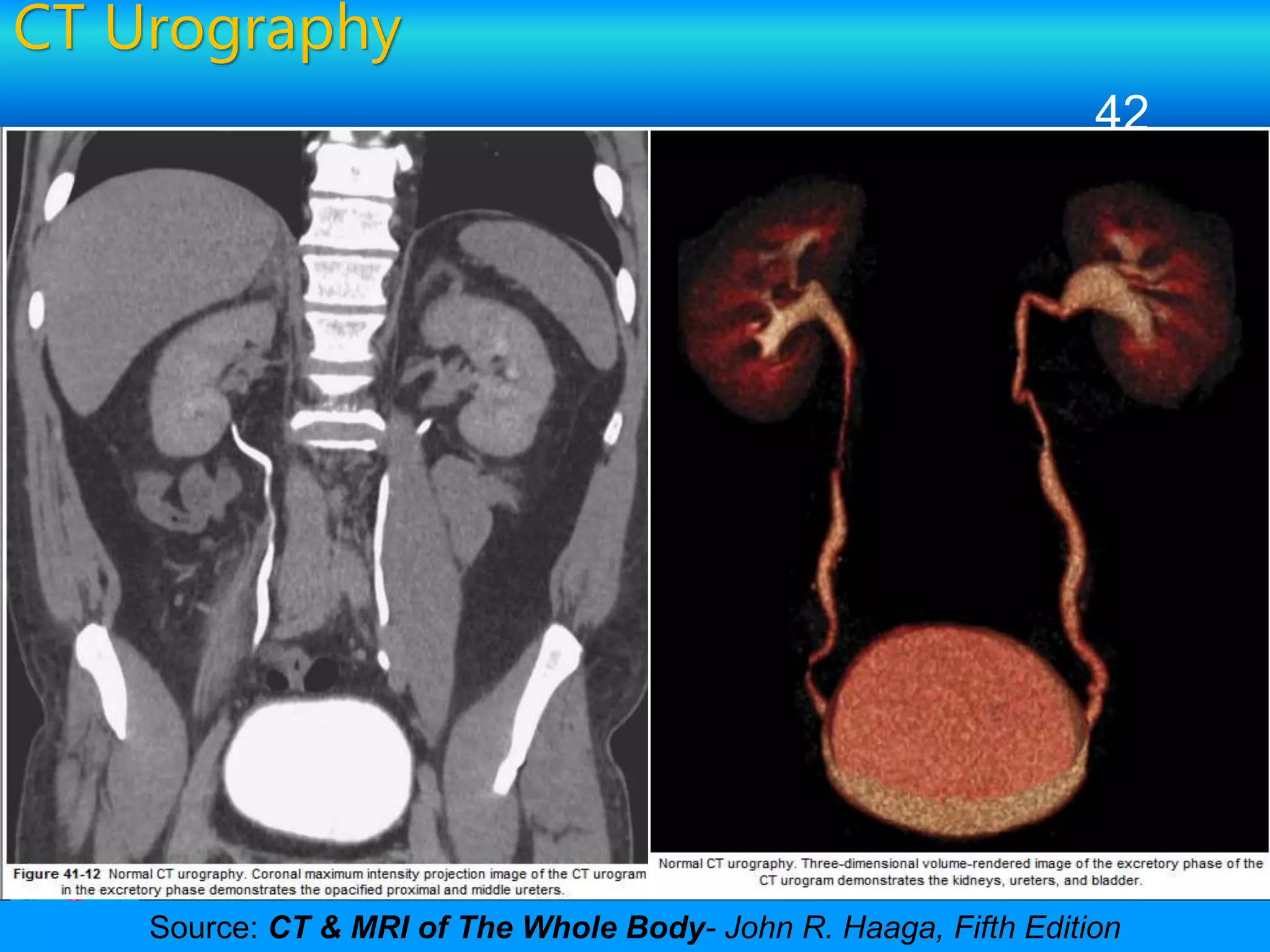 CT Procedure OF Abdomen & Pelvis | PPTX