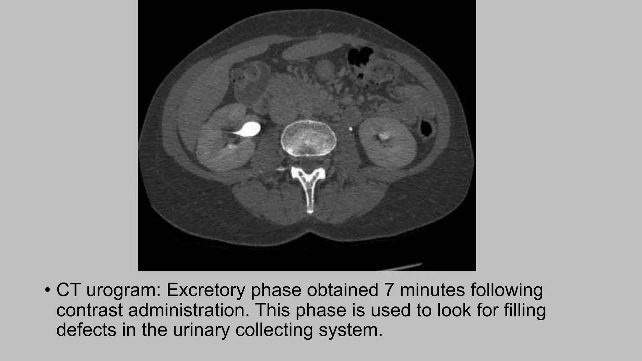 Ct protocol for ivu | PPTX