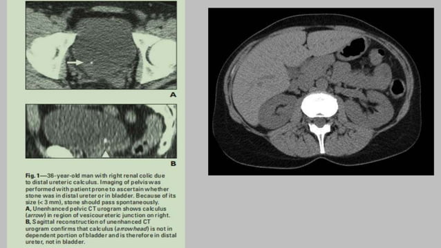 Ct protocol for ivu | PPTX