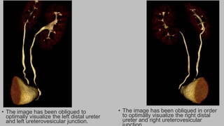 Ct protocol for ivu | PPTX