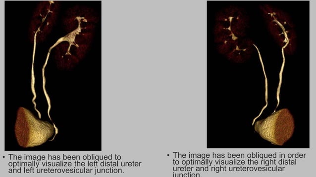 Ct protocol for ivu | PPTX