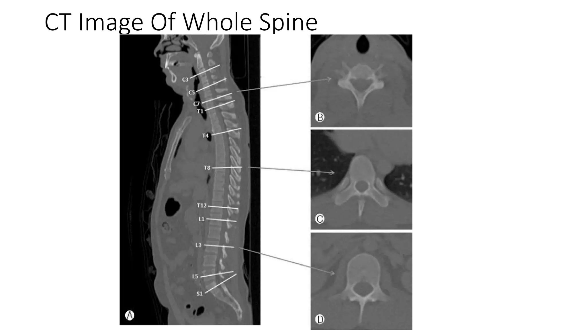 CT protocol of Spine | PPTX