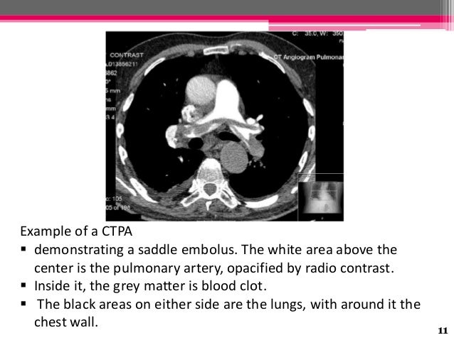 Ct pulmonary angiogram (ctpa)