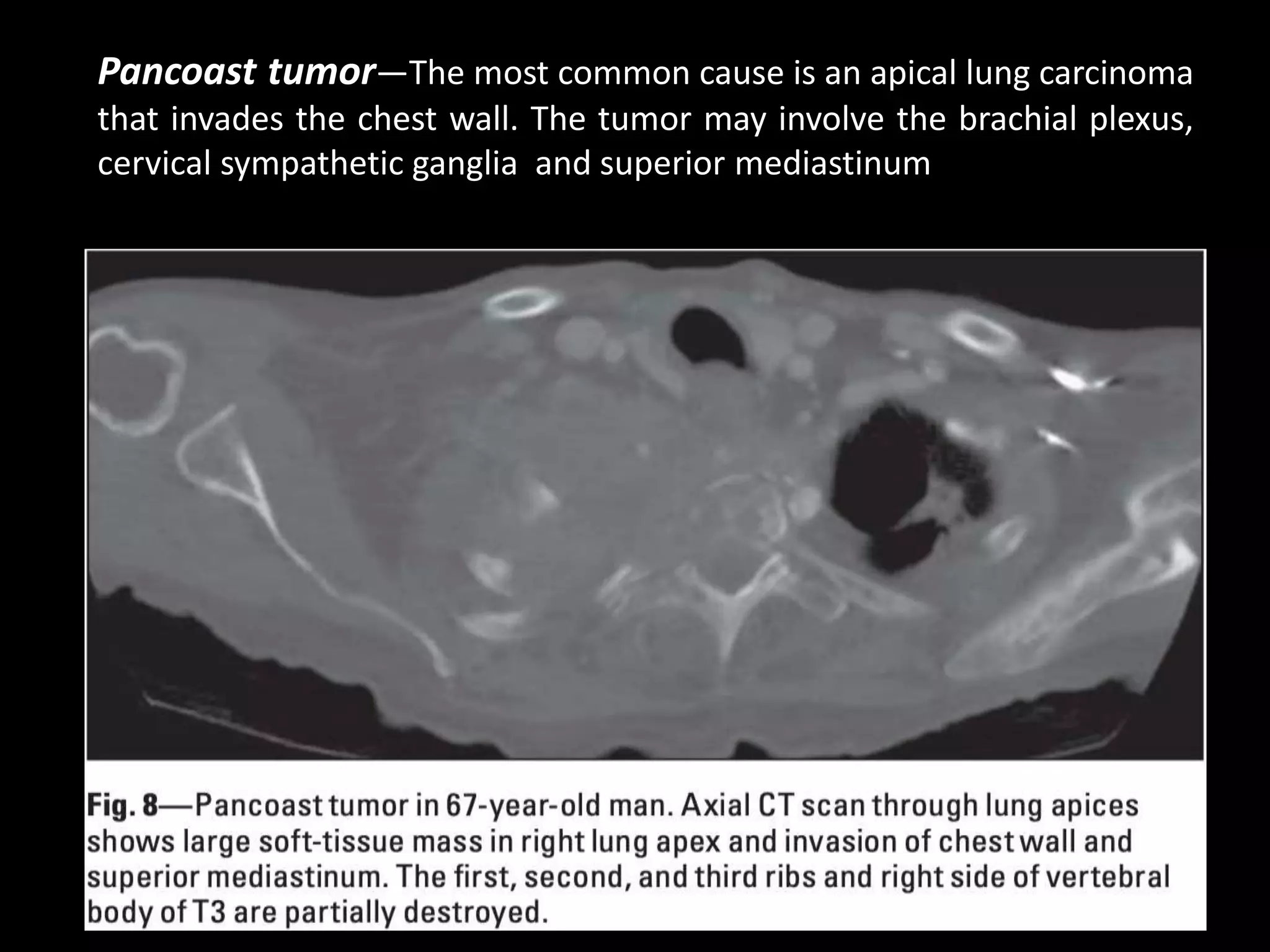 CT scan of Rib pathologies | PPTX