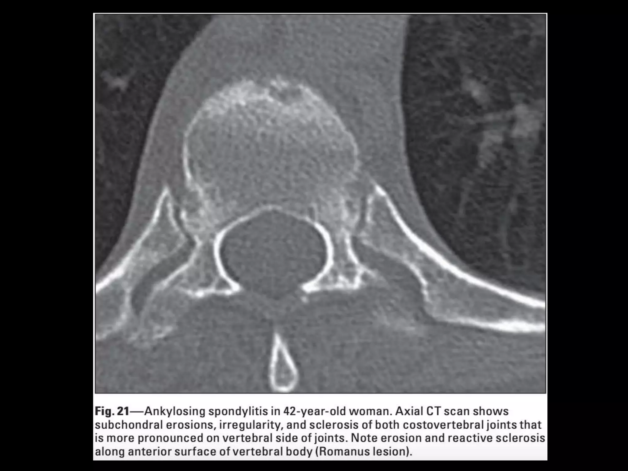CT scan of Rib pathologies | PPTX