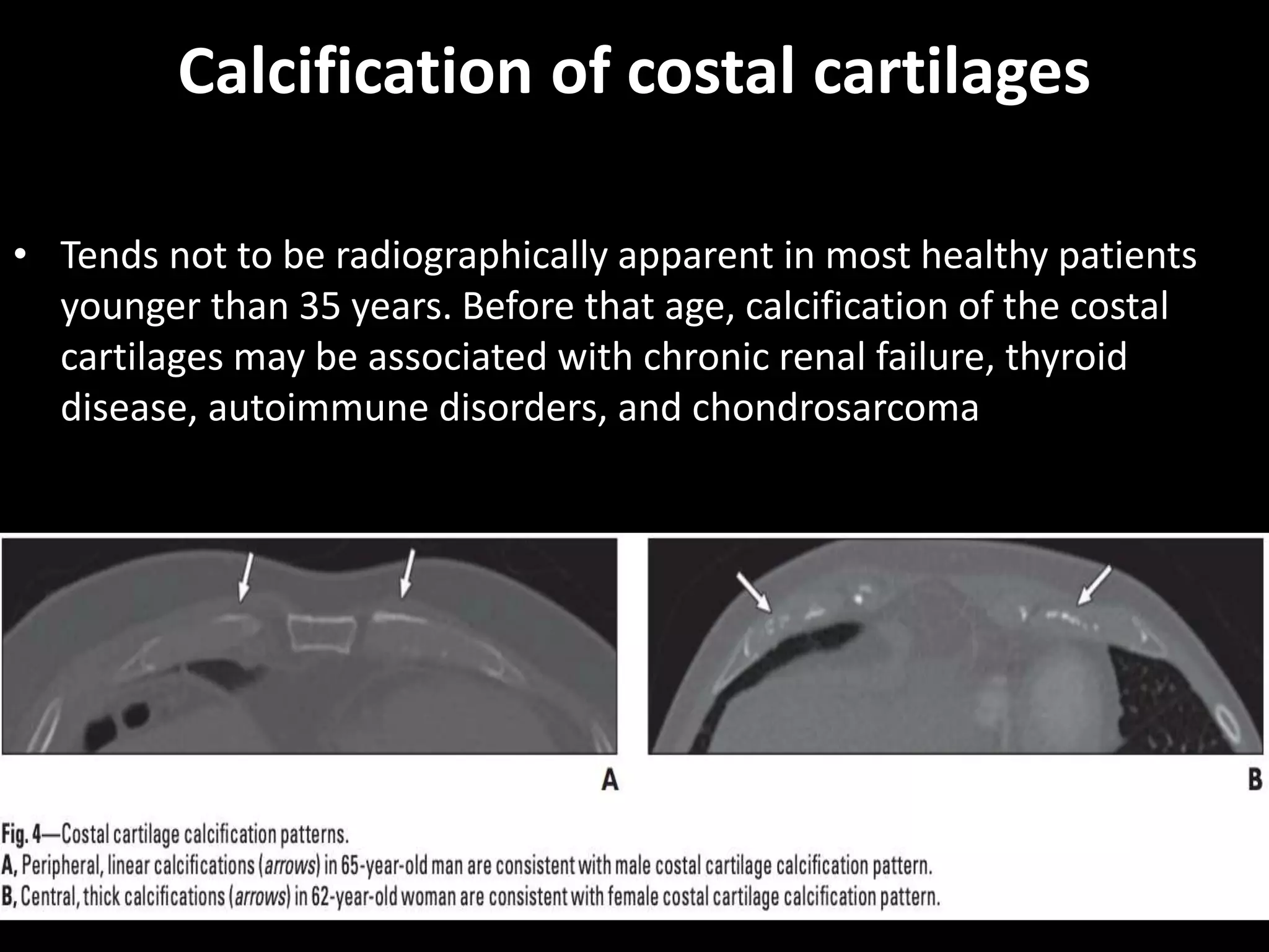 CT scan of Rib pathologies | PPTX