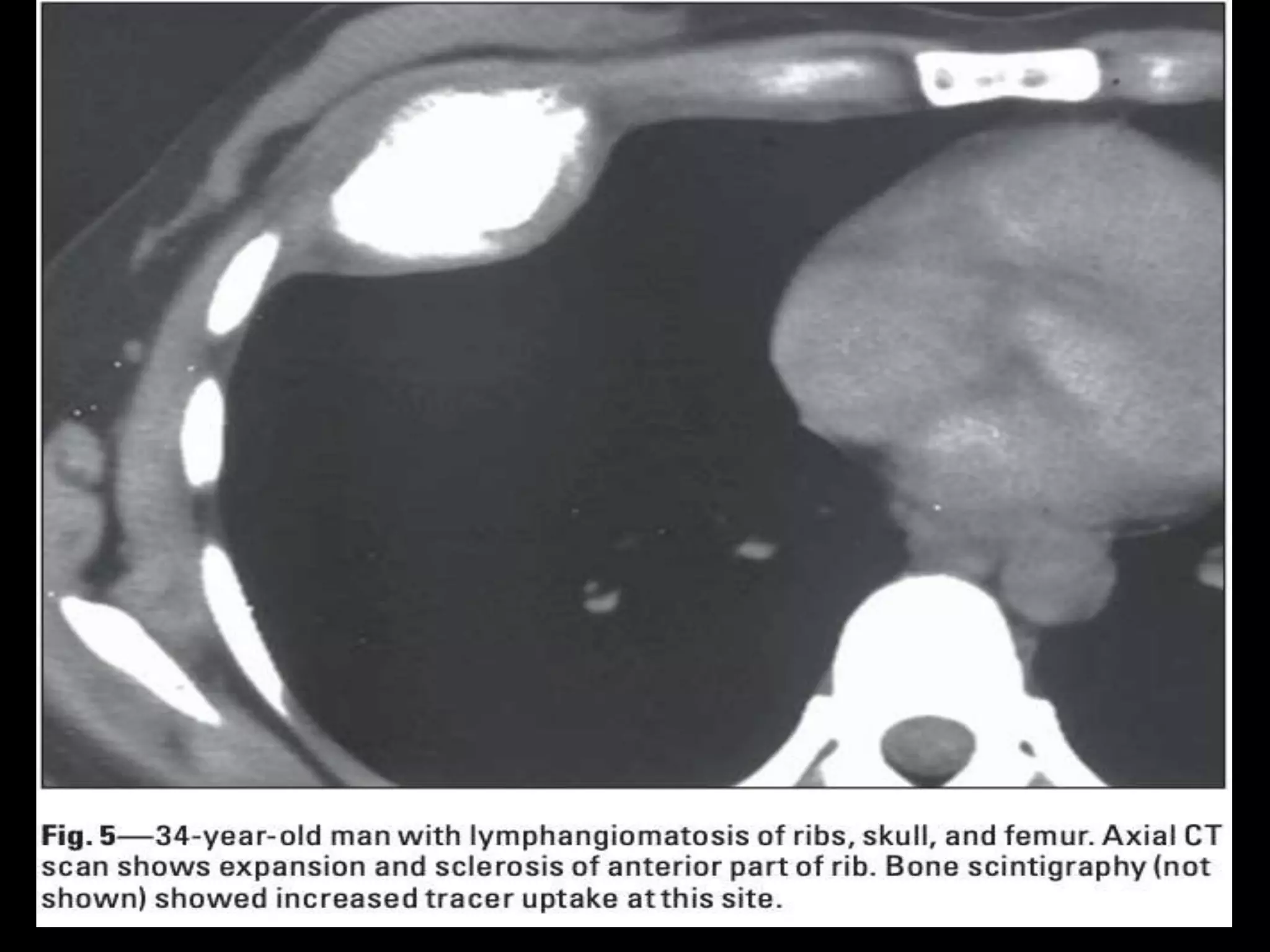 CT scan of Rib pathologies | PPTX