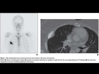 CT scan of Rib pathologies | PPTX