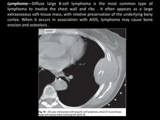 CT scan of Rib pathologies | PPTX