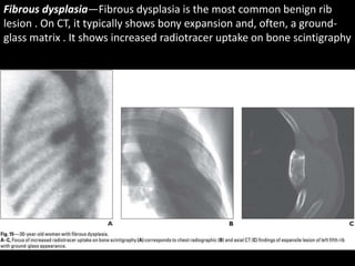 CT scan of Rib pathologies | PPTX