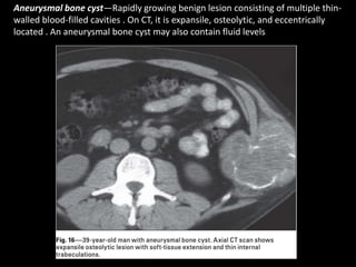 CT scan of Rib pathologies | PPTX