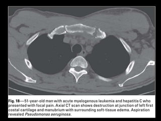 CT scan of Rib pathologies | PPTX