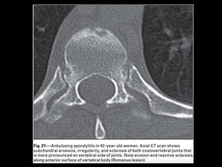 CT scan of Rib pathologies | PPTX