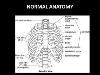 CT scan of Rib pathologies | PPTX