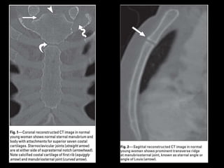 CT scan of Rib pathologies | PPTX